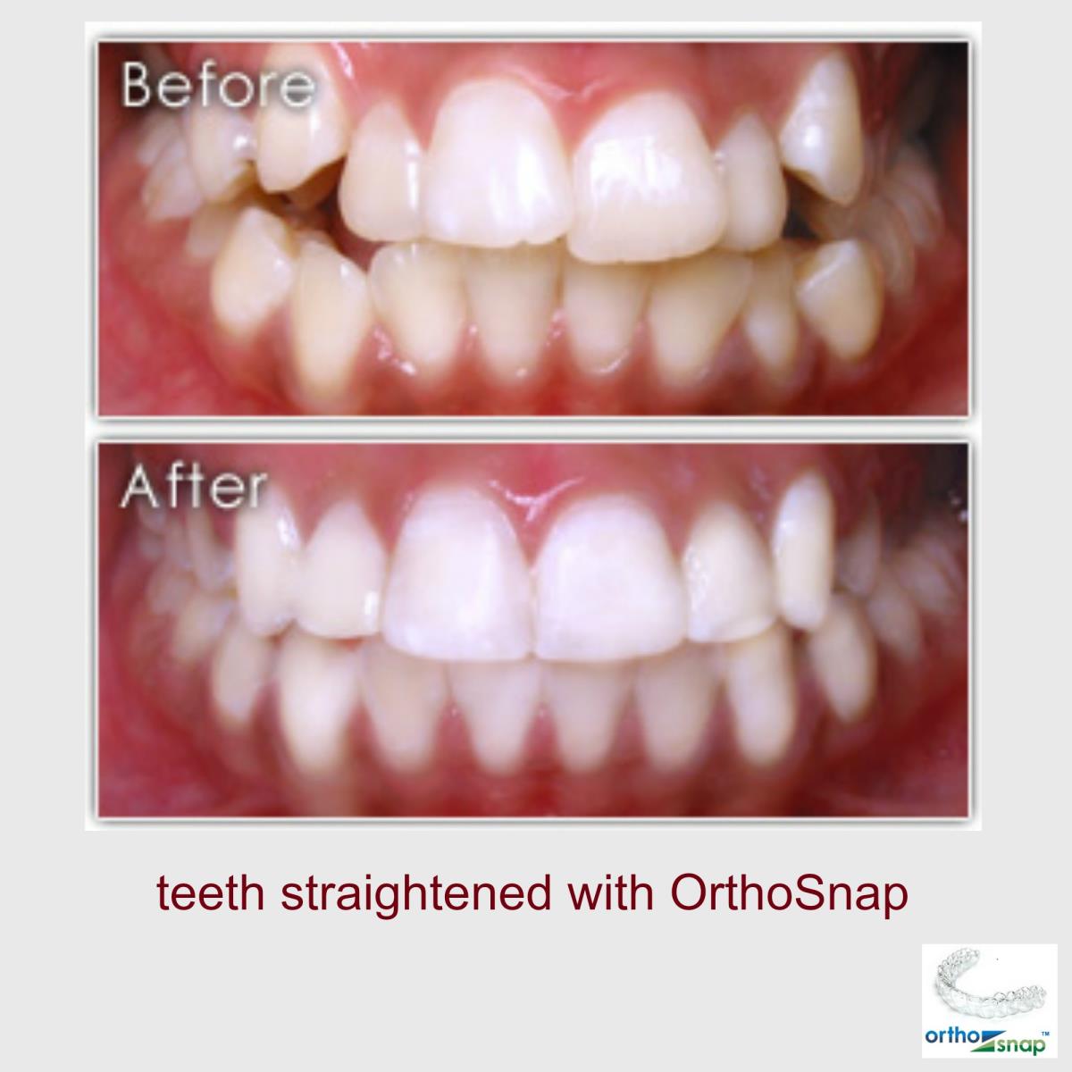 Orthosnap New York | Orthodontists, Brooklyn, NY