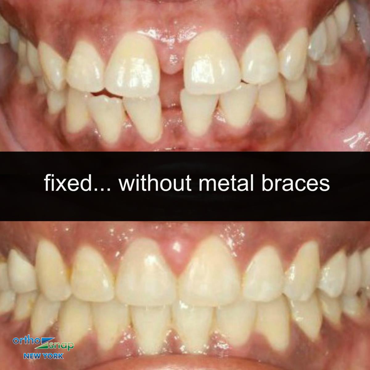 Orthosnap New York | Orthodontists, Brooklyn, NY