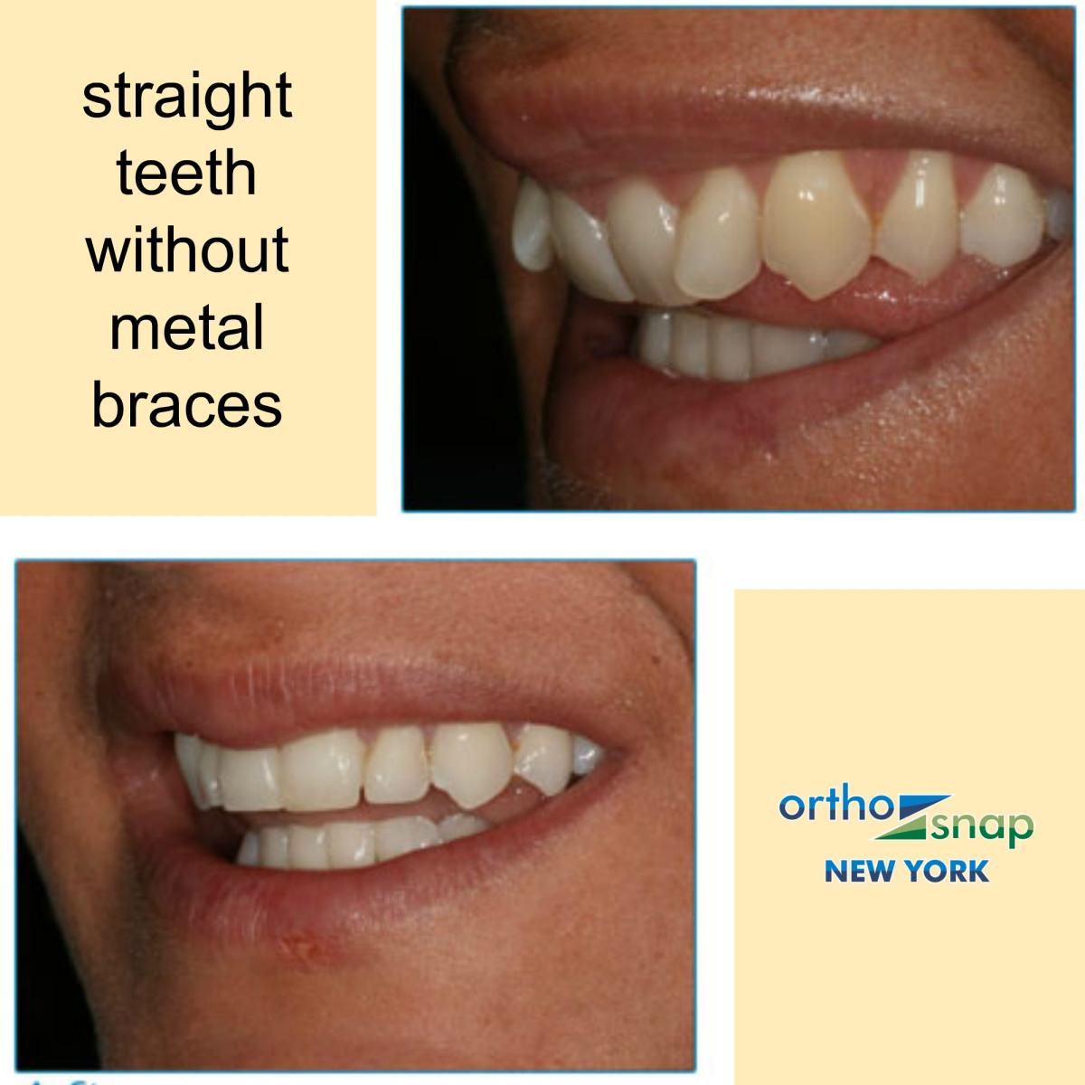 Orthosnap New York | Orthodontists, Brooklyn, NY